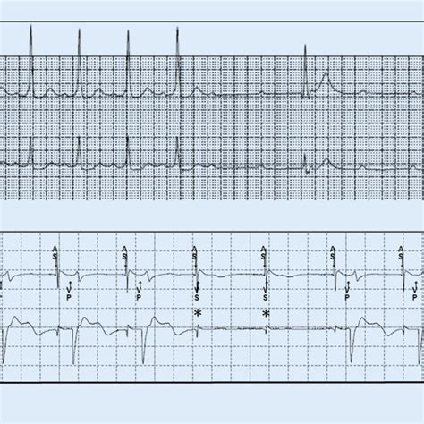 9 Patient With Complete Atrioventricular Block Implanted With A Dual