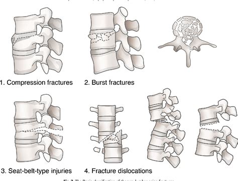 Classification Of Lumbar Fractures Design Talk