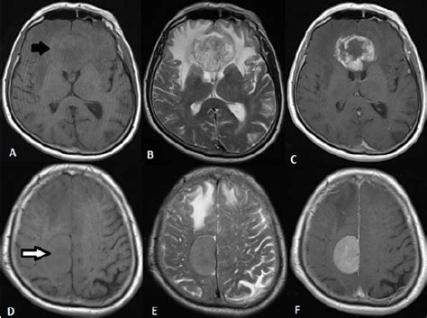 On Axial Plane T1 And T2 Weighted Brain Mr An Isointense Lesion Is