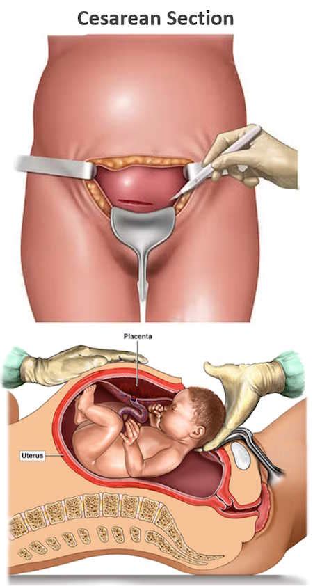 C Section Cesarean Section Procedure Risks And Recovery Doctor Zara