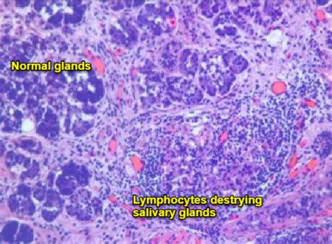 Giliver Pathology Of Upper Gi Lecture Flashcards Quizlet