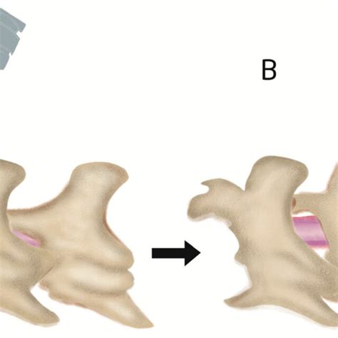 Illustration Of Intraspinal Intrathecal Injection Site And Angle First