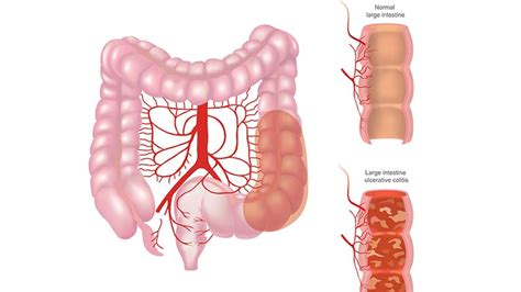 Cancer Risk High In Ulcerative Colitis Varies By Age