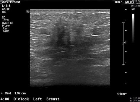 Correlation Between Ultrasound Findings And Molecular Subtypes Of