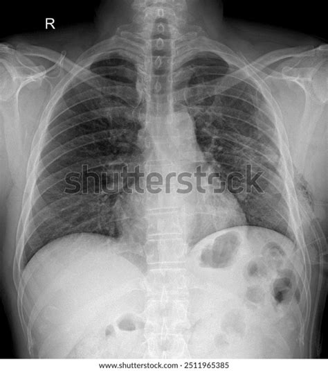 10 chest cavity visualization royalty free photos and stock images shutterstock