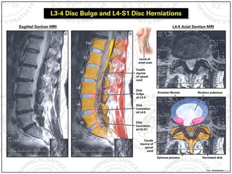 L Disc Bulge And L S Disc Herniations