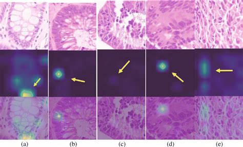 Limitations Of Deep Learning Based Colorectal Cancer Classification A