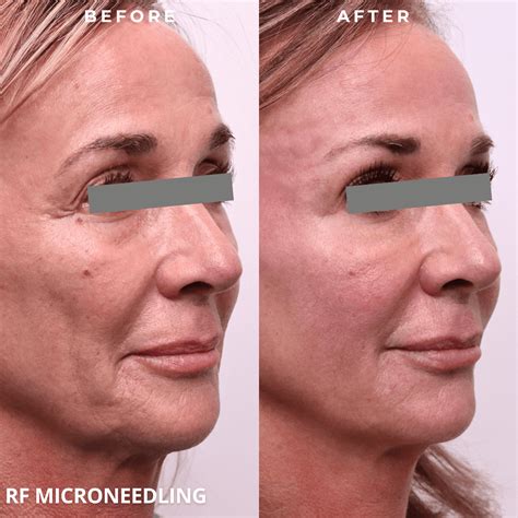 What Is Rf Microneedling