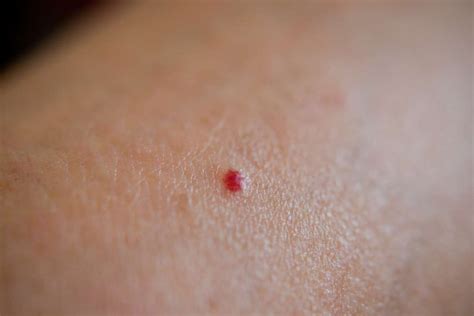 Puntos Rojos En La Piel Causas Y Características Clínica Jaime Vilar