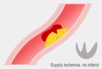 Angina Flashcards Quizlet