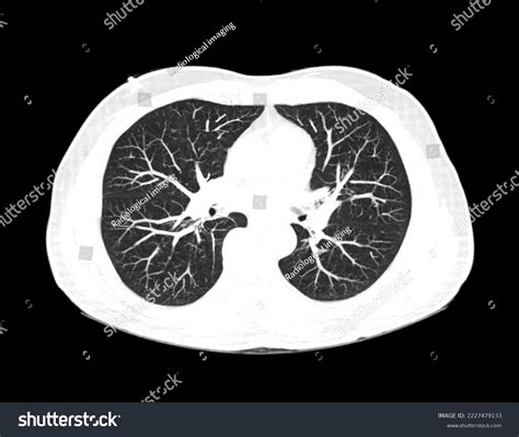 Ct Scan Chest Lung Axial View Stock Illustration 2227479133 Shutterstock