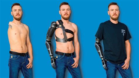 Harnesses And Upper Limb Prostheses