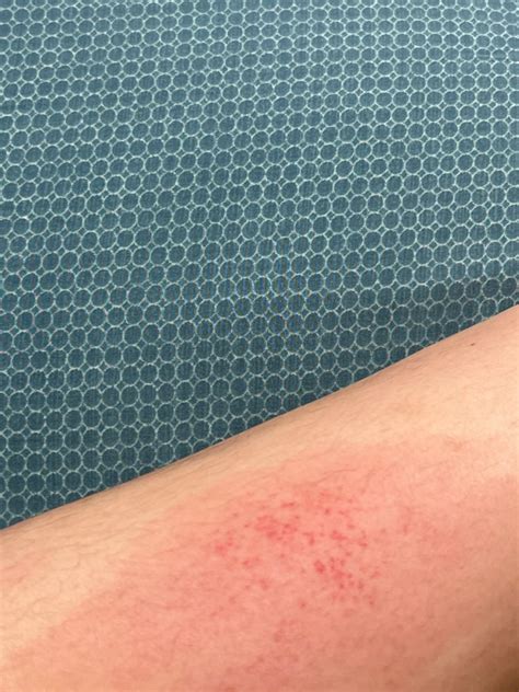 간지러워서 긁었더니 피부 빨개진 지식in