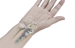 Wrist Arthroscopy Montgomery Al Microvascular Surgery Wetumpka Al