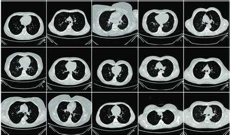 Raw Control Ct Slices Images Taken From Novmed Dataset Download Scientific Diagram