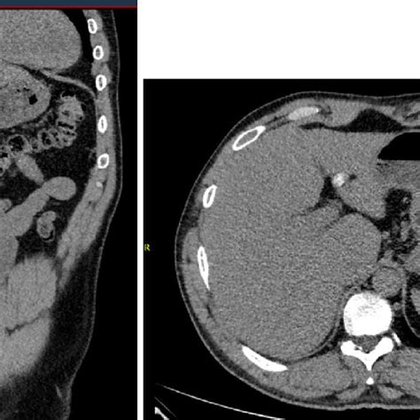 Ct Showing Calcified Cyst In Segment Iii Of The Liver Download Scientific Diagram