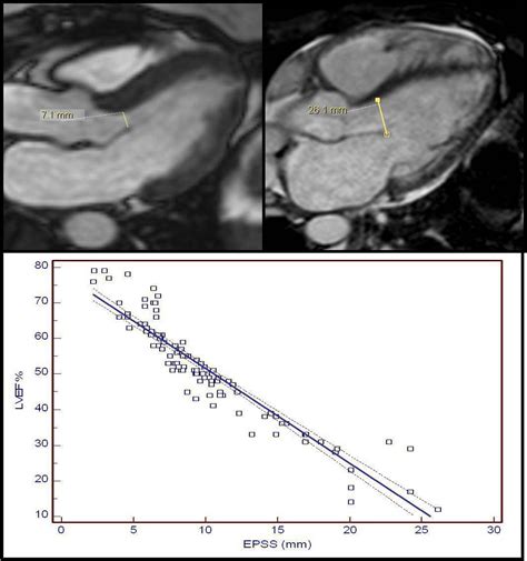 Mitral Valve E Point To Septal Separation Epss Measurement By Cardiac
