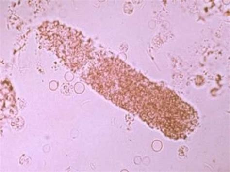 Atlas De Sedimento Urinario Urinarios Sedimentarias Eritrocitos