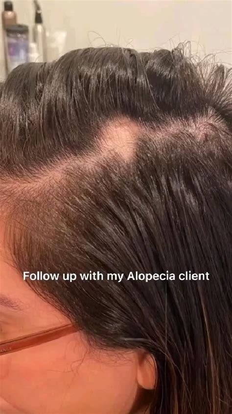 Alopecia Areata Hair Loss Causes Symptoms Treatments Artofit