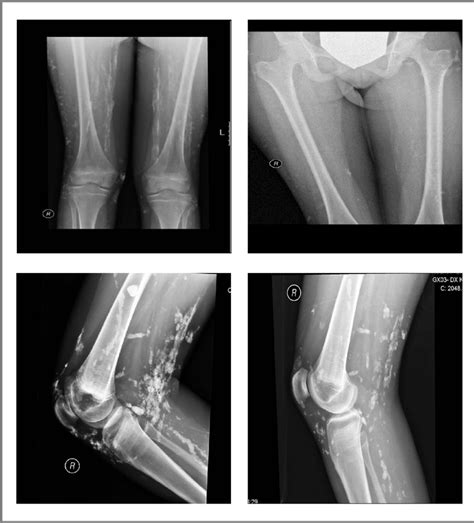 Calcinosis In Case 2 Upper And Case 4 Lower Involving Subcutaneous