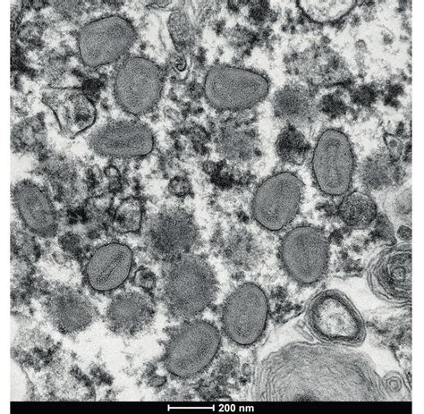 Monkeypox Infection Presenting As Genital Rash Australia May