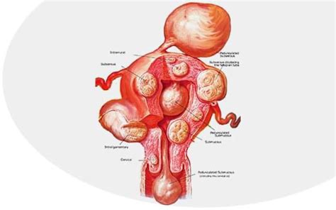 Умайн хоргүй хавдар буюу Бү До эмэгтэйчүүдийн эмнэлэг Facebook