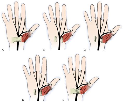 Compression Neuropathies Clinical Tree