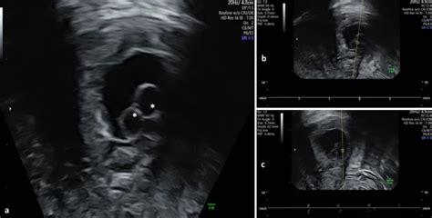 Twin Interstitial Ectopic Pregnancy Medizzy Journal