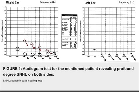 Figure 1 From Successful Cochlear Implantation For Intracochlear Fibrosis Semantic Scholar