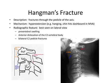 X Ray C Spine Pptx