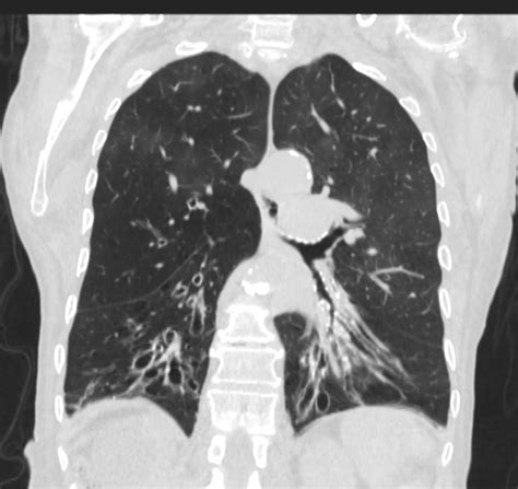 154lu Bronchiectasis The Common Vein