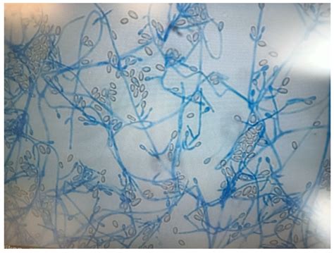 Invasive Fungal Infection By Scedosporium Apiospermum With Cerebral