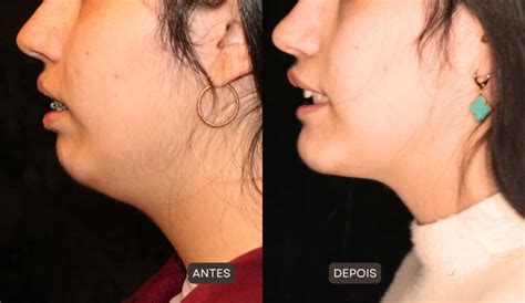 Queixo Para Dentro E Rosto Cansado Qual A Relação E Como Corrigir
