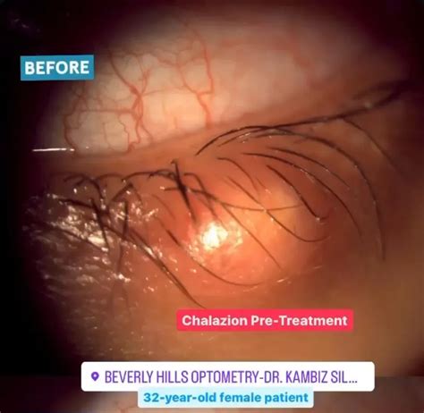 Meibomian Gland Probing Mgp And Chronic Chalazion Treatment