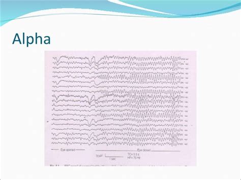 Eeg Basics Ppt