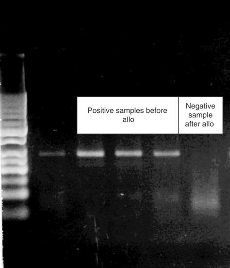 Molecular Results In Patients Treated With Allogeneic Stem Cell Download Scientific Diagram