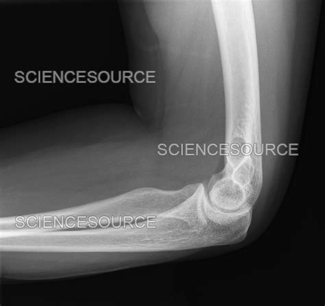 Elbow X Ray
