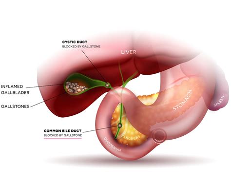 Bile Duct Stones Symptoms And Treatment Nexus Surgical