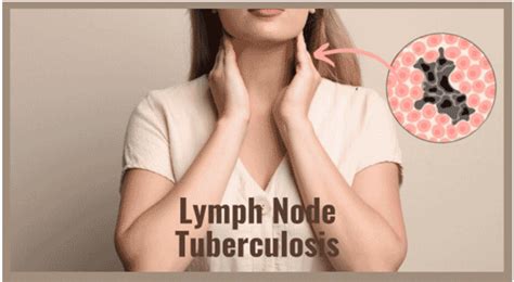Extrapulmonary Tuberculosis Symptoms Tuberculosis Causes Symptoms