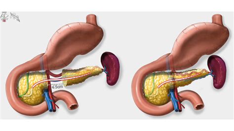 Minimally Invasive Versus Open Central Pancreatectomy Systematic Review And Meta Analysis Hpb