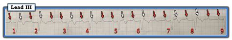 Ecg Interpretation Ecg Blog 347 — Why Non Conducted P Waves