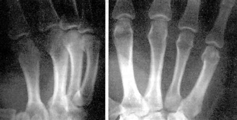Xhand Startradiology In 2020 Radiology Hand Injuries