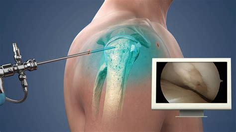 Arthroscopic Shoulder Synovectomy Hip Knee Shoulder Surgeon Newcastle Dr Ben Mcgrath