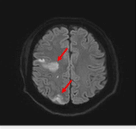 Axial Mr Diffusion Weighted Image On Day 2 Of Admission The Red Arrows