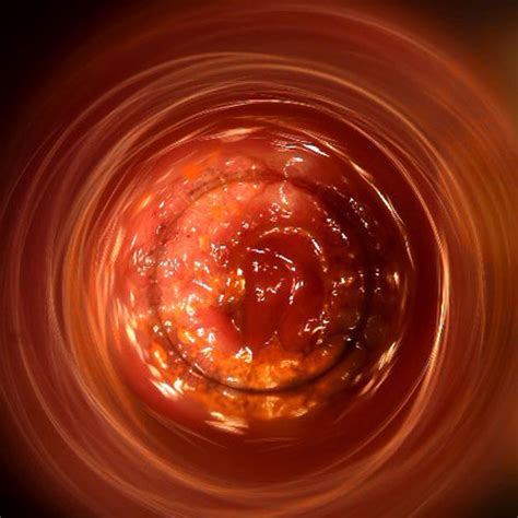 La Proctite E Lanite Linfiammazione Dellano