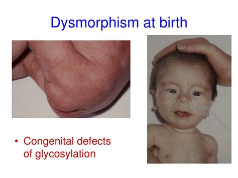 Ppt Neonatal Presentations Of Inborn Errors Of Metabolism Powerpoint