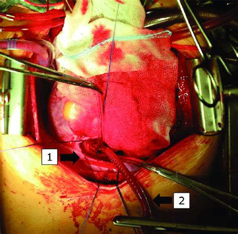 Cannulation Descending Aorta Selective Cannulation Of The Descending