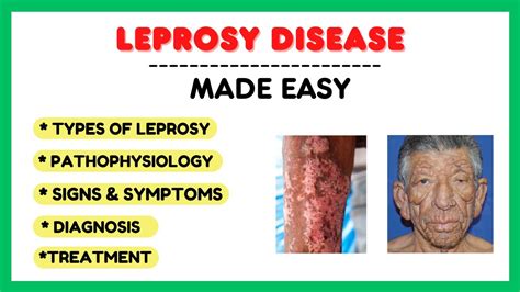 Leprosy Symptoms Leprosy Springerlink