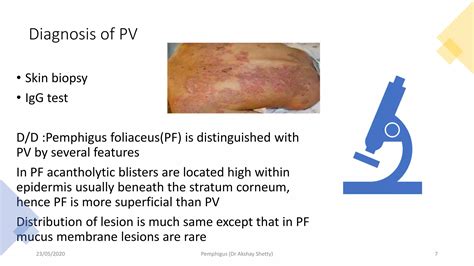 Pemphigus Pptx