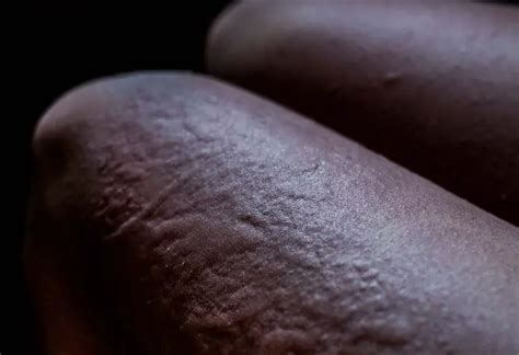 Whats Really Causing Your Hives Uncover These Unexpected Triggers